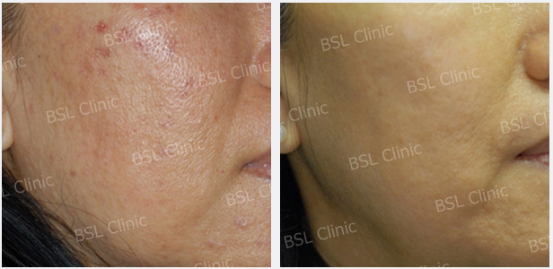 Acne Cure & Treatment, Acne Scar, Acne Blemish - Bangkok Aesthetic Clinic