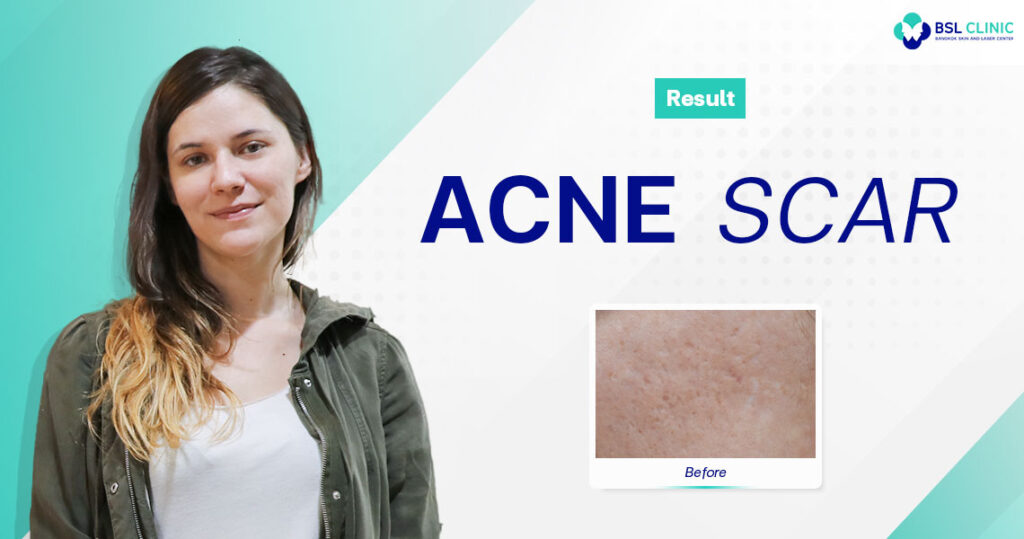 Effective Acne Scar Solutions: Improve the Look of Scars