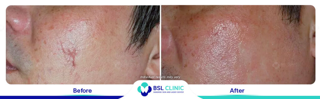 Effective Acne Scar Solutions: Improve the Look of Scars