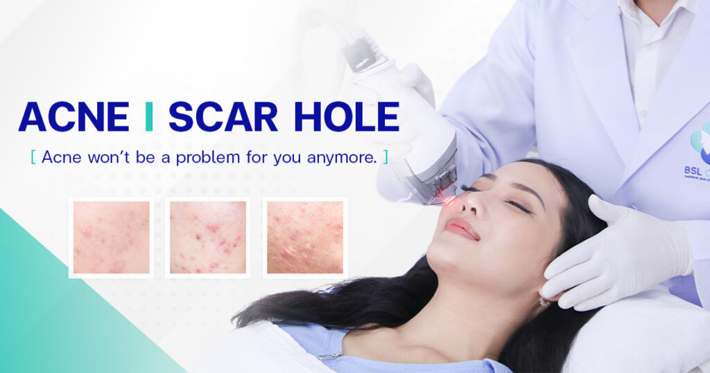 Acne Scarring and Blemish Treatment